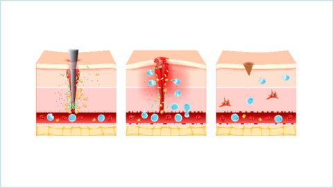 Bionect® zur Wundheilung und Schutz Ihrer Wunde | Mit Hyaluron