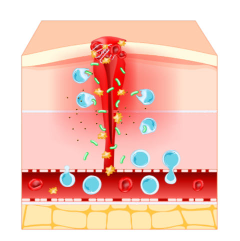 Wundheilung mit Hyaluronsäure | Bionect® Creme & Control Spray